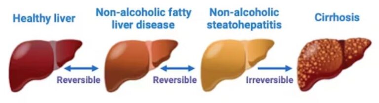 MASLD (fatty liver disease) – Bradford Teaching Hospitals NHS ...