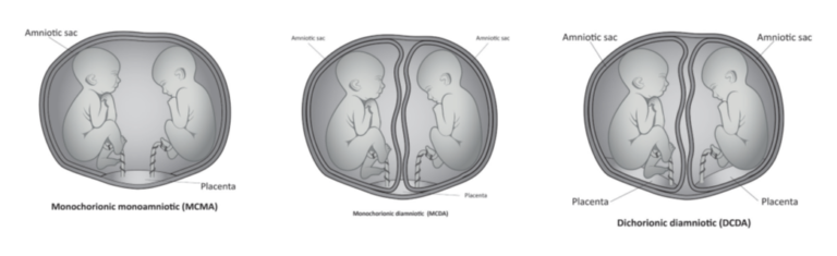 Multiple pregnancies: twins, triplets & more – Bradford Teaching ...
